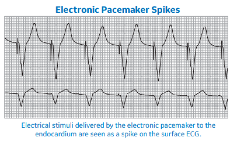 Arrhythmia Recognition Part 2 Clinical View